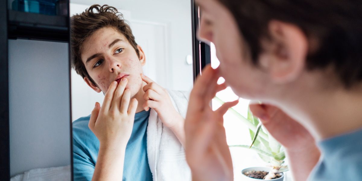 Acne: che cos'è e i migliori rimedi per prevenirla e trattarla