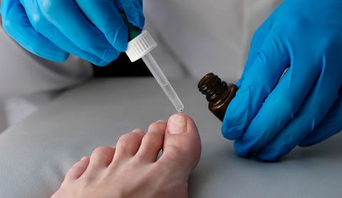 Onicomicosi: i 5 migliori prodotti per trattare l'infezione fungina