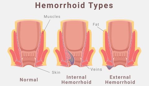 Emorroidi: cosa sono, come trattarle ed evitarle