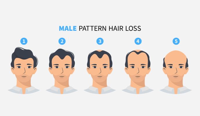 Calvizie uomo: cos'è, cause e rimedi utili