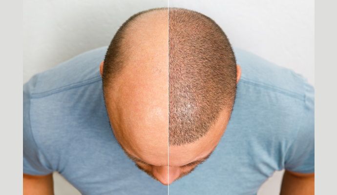 Calvizie uomo: cos'è, cause e rimedi utili