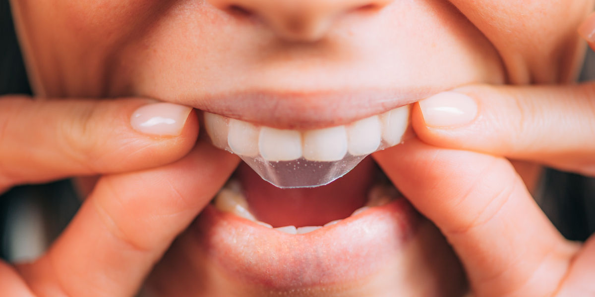 Strisce sbiancanti per i denti: come si utilizzano?